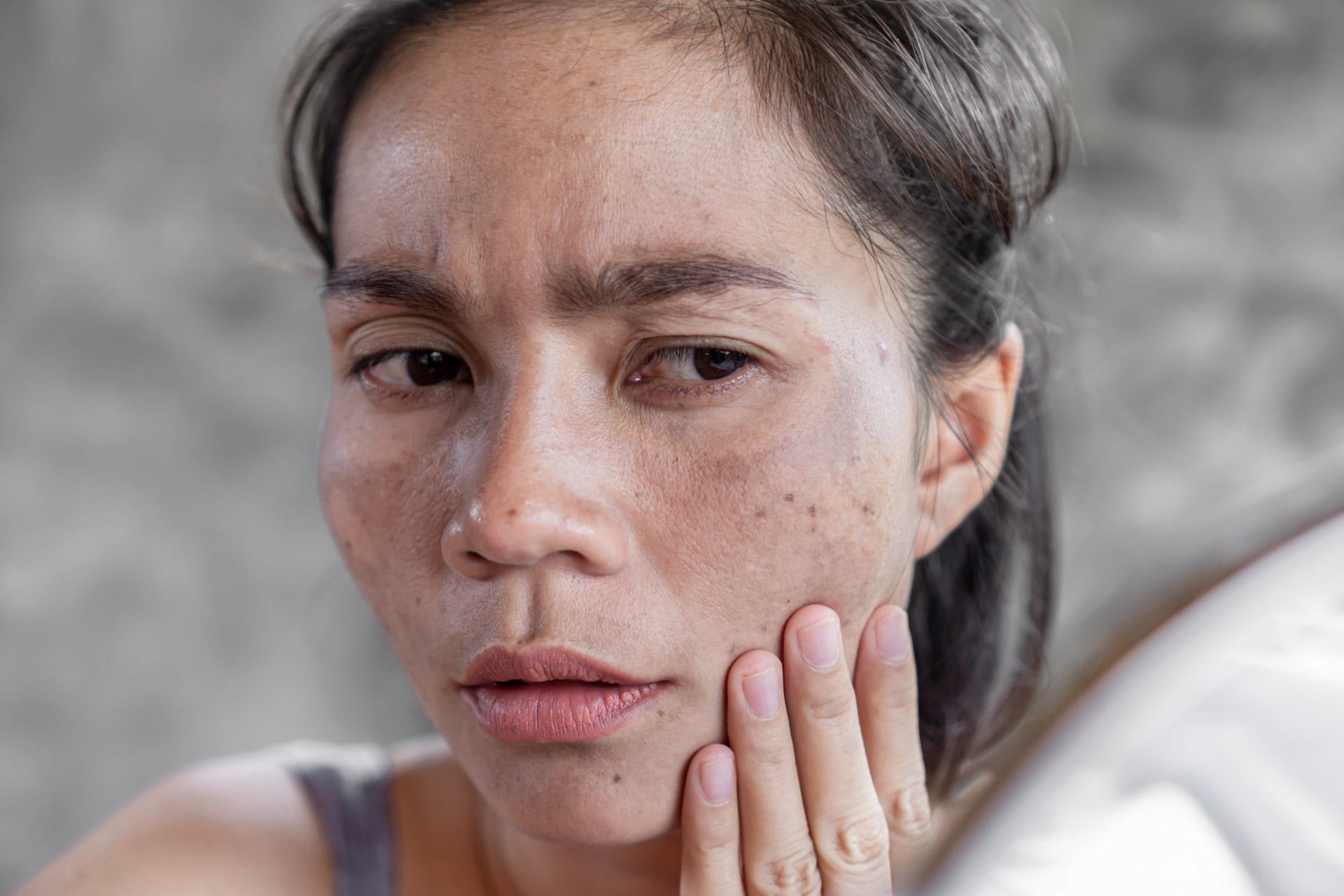 Sublative RF Treatments Give You Brighter, Younger-Looking Skin