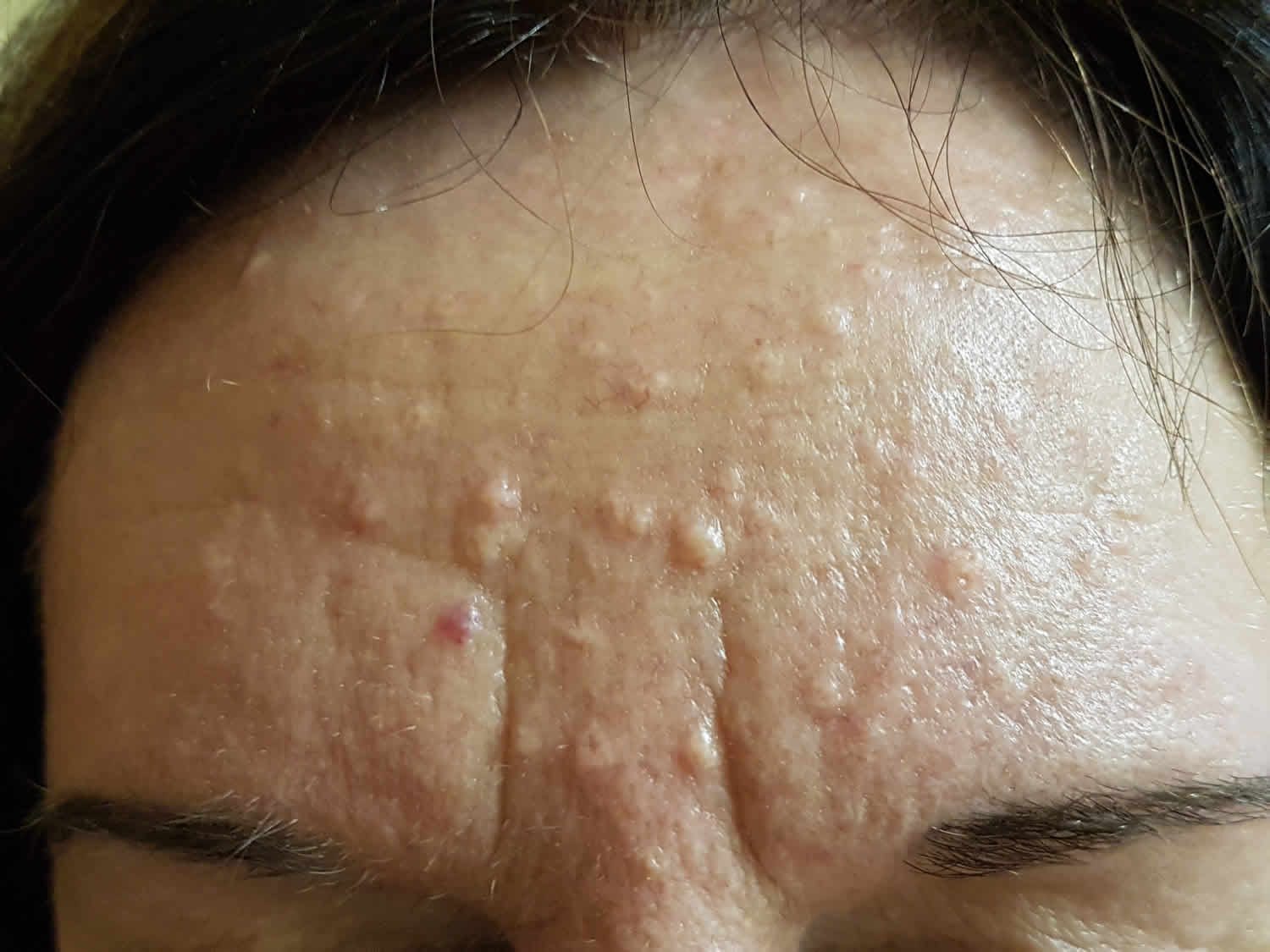 What Is Sebaceous Hyperplasia Treatment